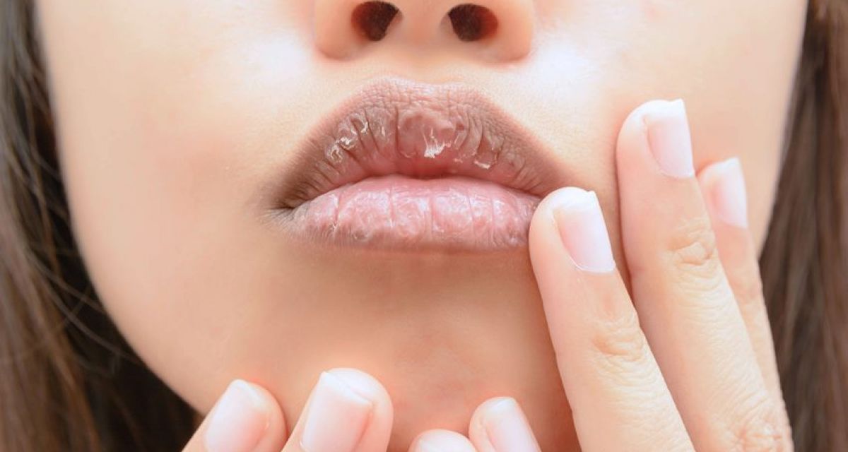 Evita los labios partidos